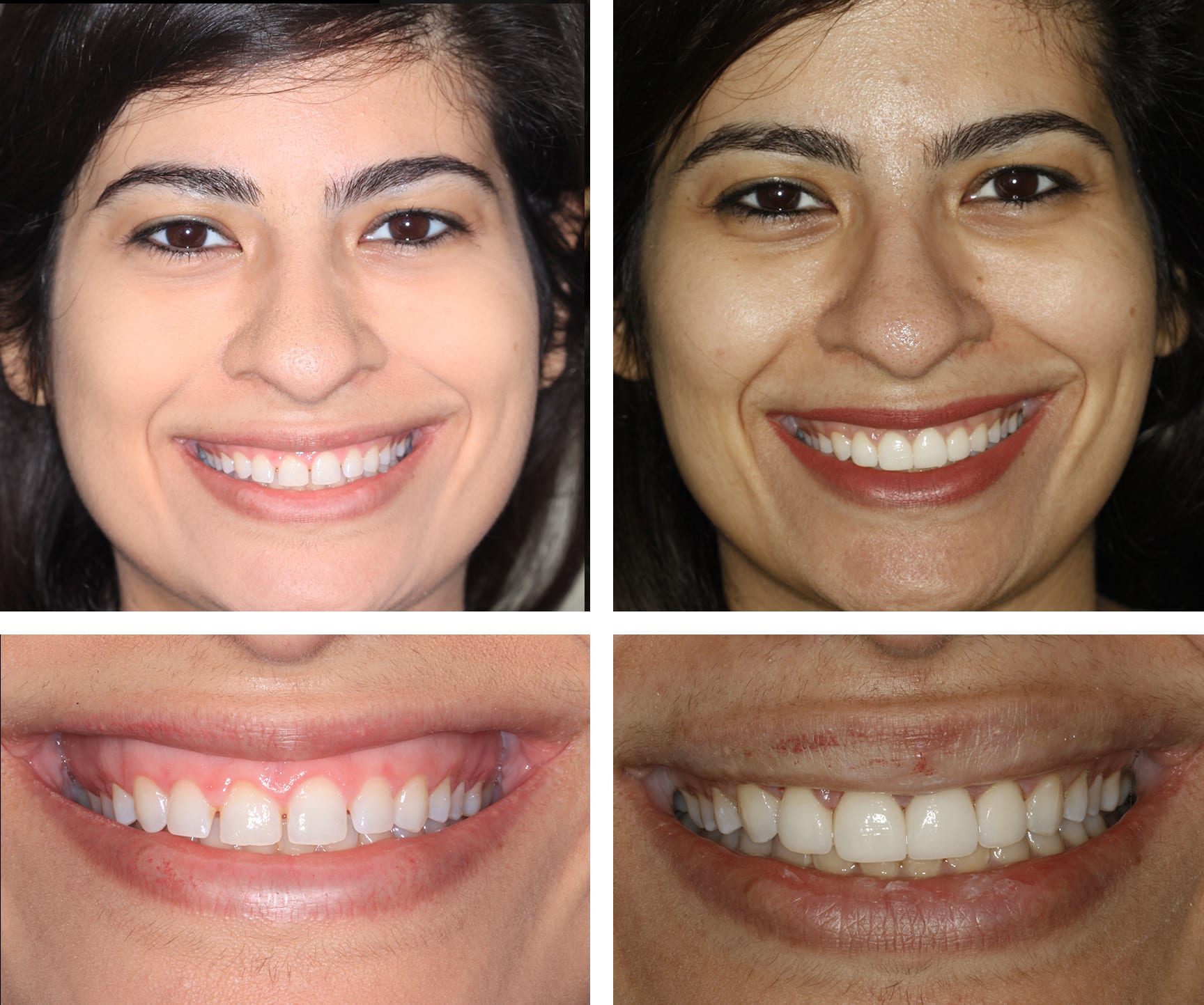 Gum Lift: Elevating Smiles in Vienna, VA with Dr. Makarita - Tysons ...